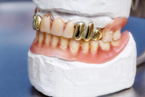 How Much Is a Gold Tooth Worth? Get a Quick Valuation Online!